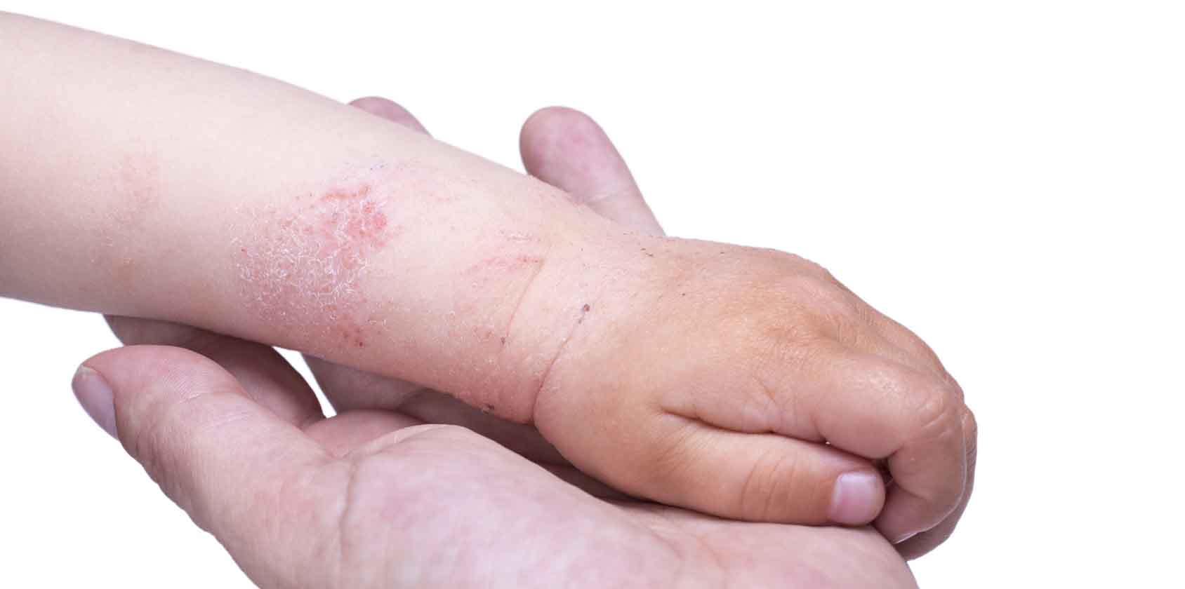 Objawy alergii skórnej - zmiany skórne i alergia - co powinniśmy wiedzieć? Objawy alergii skórnej - zmiany skórne i alergia - co powinniśmy wiedzieć?